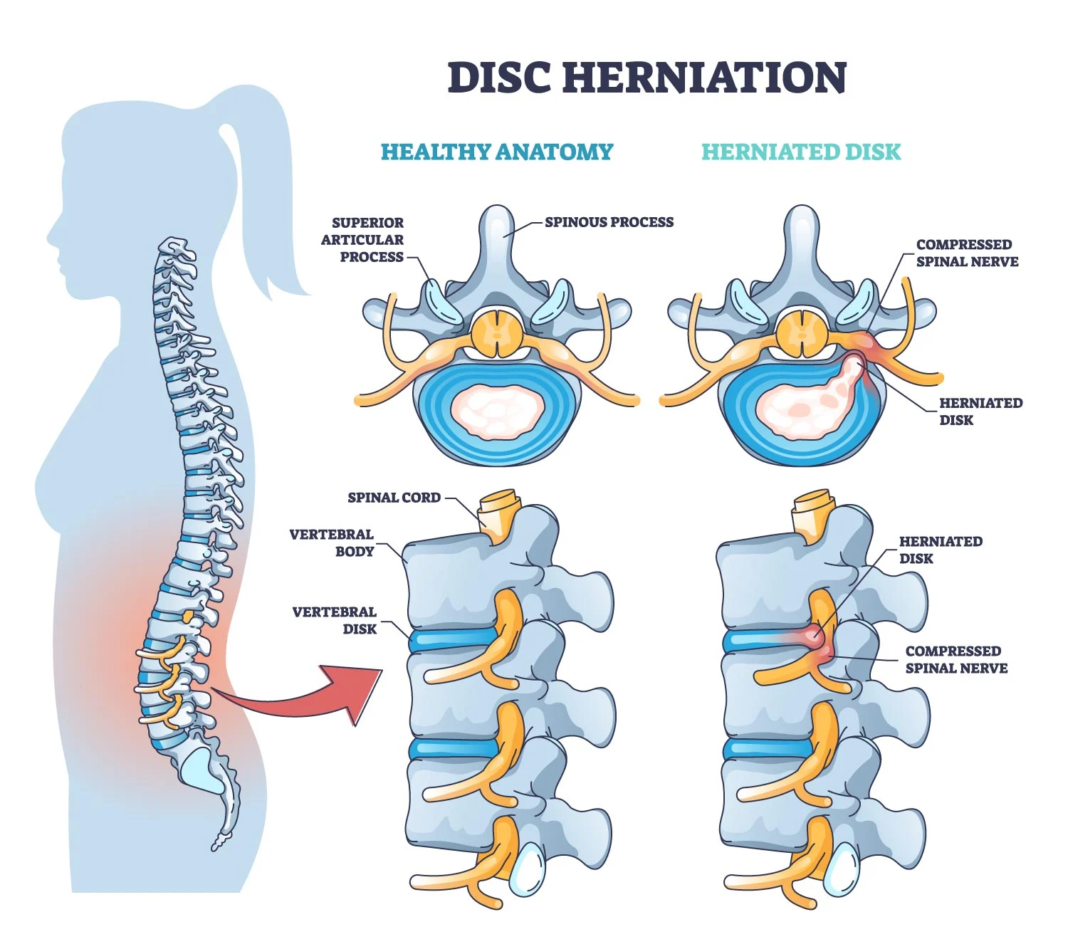 หมอนรองกระดูกทับเส้นประสาท (Herniated Disc) - บอดี้แอนด์มายด์